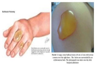 Management of some commonly used drugs toxicity | PPT