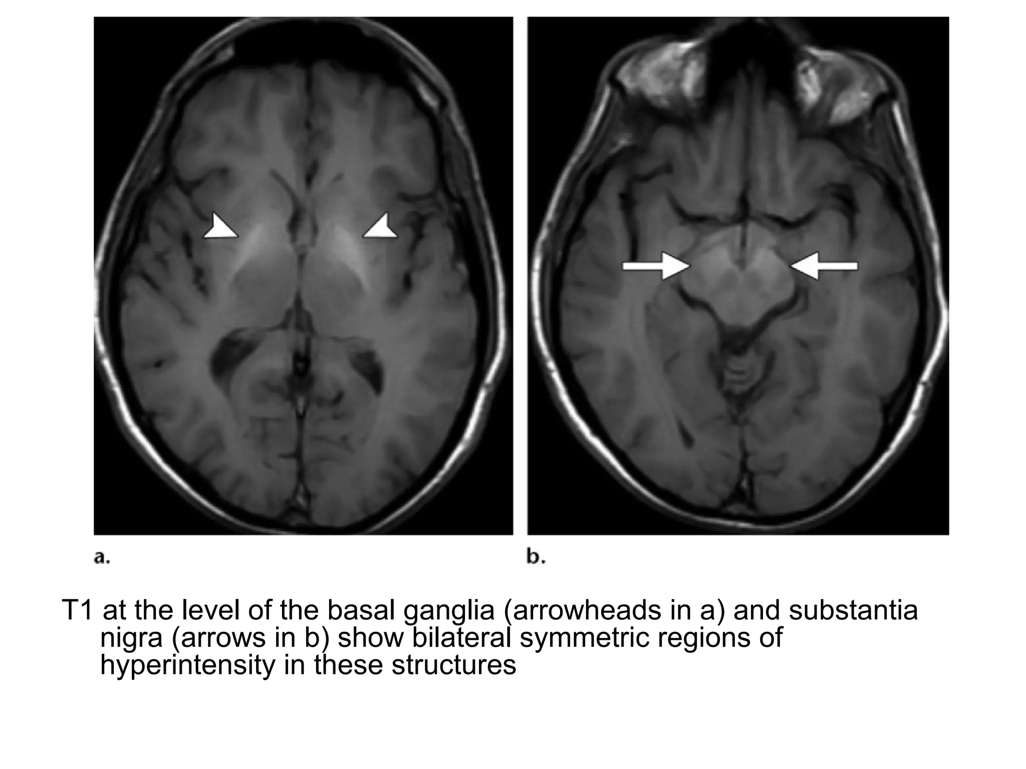 Diagnostic Imaging of Cerebral Toxic & Metabolic Diseases | PPT
