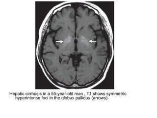 Diagnostic Imaging of Cerebral Toxic & Metabolic Diseases | PPT