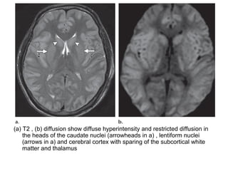 Diagnostic Imaging of Cerebral Toxic & Metabolic Diseases | PPT