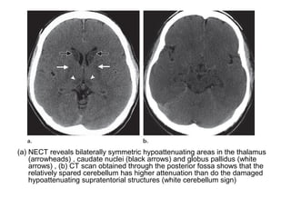 Diagnostic Imaging of Cerebral Toxic & Metabolic Diseases | PPT