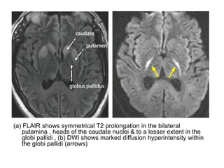 Diagnostic Imaging of Cerebral Toxic & Metabolic Diseases | PPT