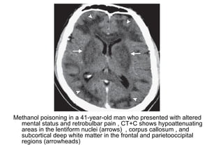 Diagnostic Imaging of Cerebral Toxic & Metabolic Diseases | PPT