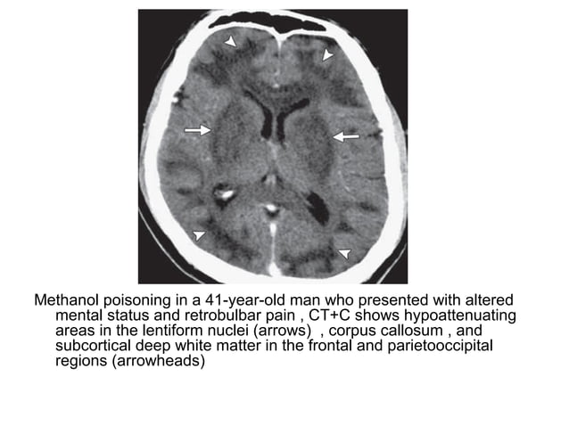 Diagnostic Imaging of Cerebral Toxic & Metabolic Diseases | PPT | Brain ...