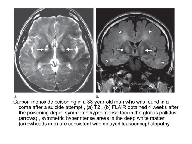 Diagnostic Imaging of Cerebral Toxic & Metabolic Diseases | PPT | Brain ...