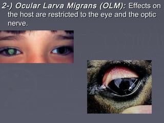 About ToToxocari̇asi̇s | PPT