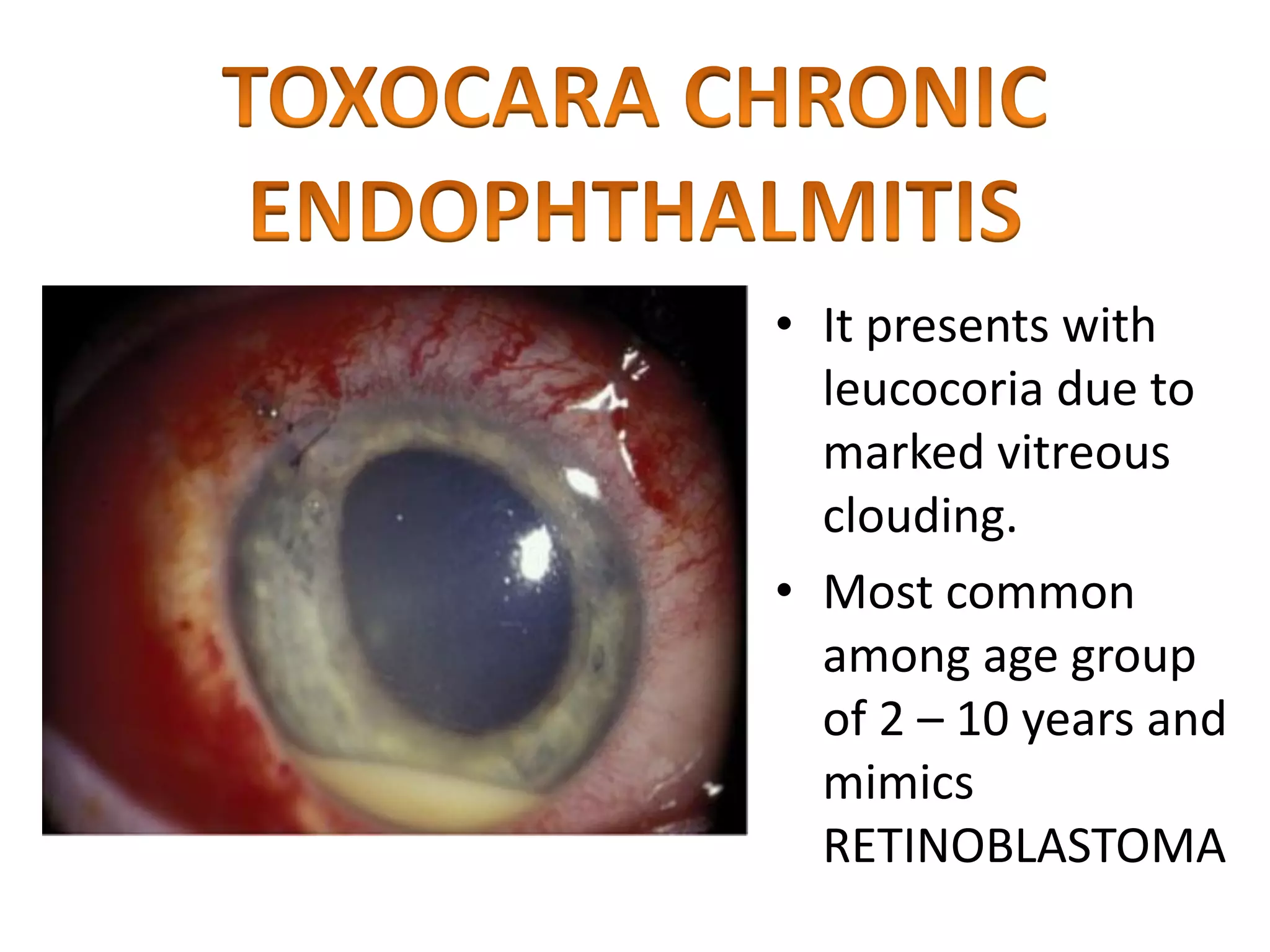 Toxocariasis | PDF