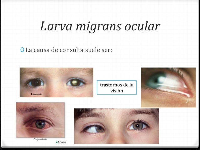 Ocular Larva Migrans.