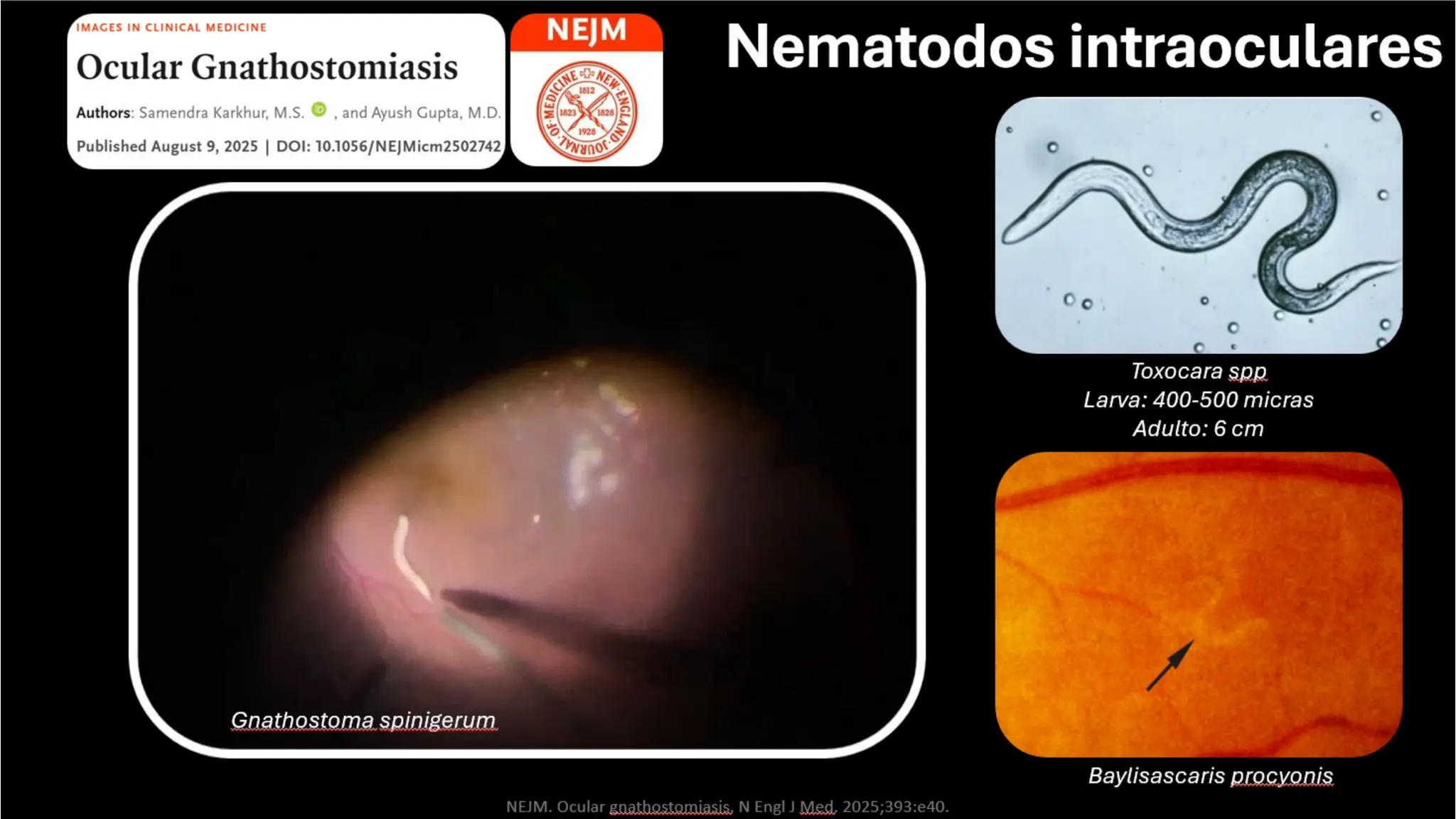 Toxocariasis ocular (Larva migrans, Toxocara canis y cati, helmintos ...