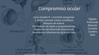 Toxocariasis ocular (Larva migrans, Toxocara canis y cati, helmintos ...