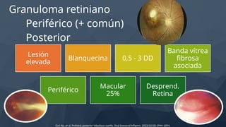Toxocariasis ocular (Larva migrans, Toxocara canis y cati, helmintos ...