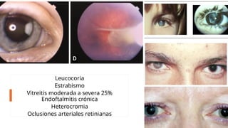 Toxocariasis ocular (Larva migrans, Toxocara canis y cati, helmintos ...