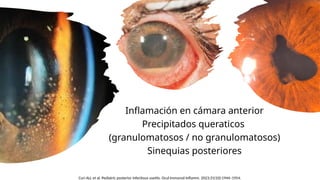 Toxocariasis ocular (Larva migrans, Toxocara canis y cati, helmintos ...