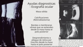 Toxocariasis ocular (Larva migrans, Toxocara canis y cati, helmintos ...