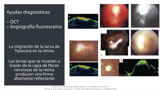 Toxocariasis ocular (Larva migrans, Toxocara canis y cati, helmintos ...