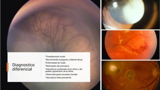 Toxocariasis ocular (Larva migrans, Toxocara canis y cati, helmintos ...