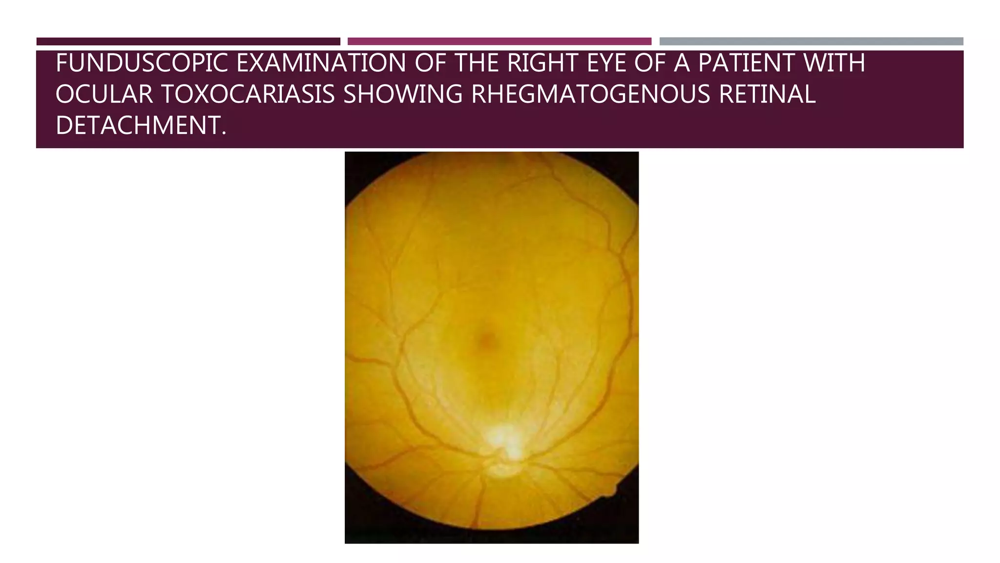 Toxocariasis (roundworms) | PPTX