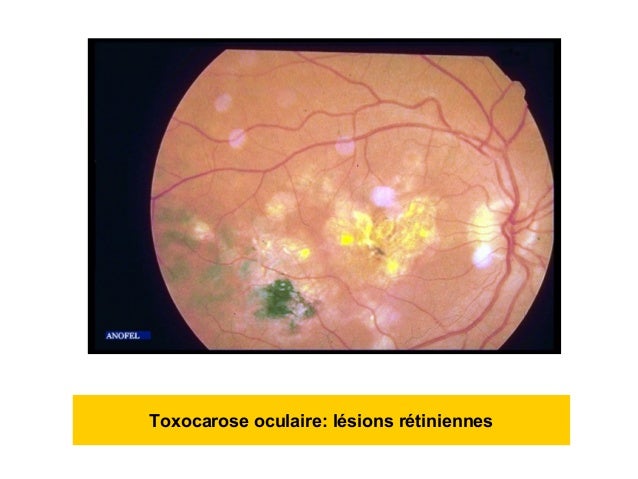 Toxocarose trichinellose