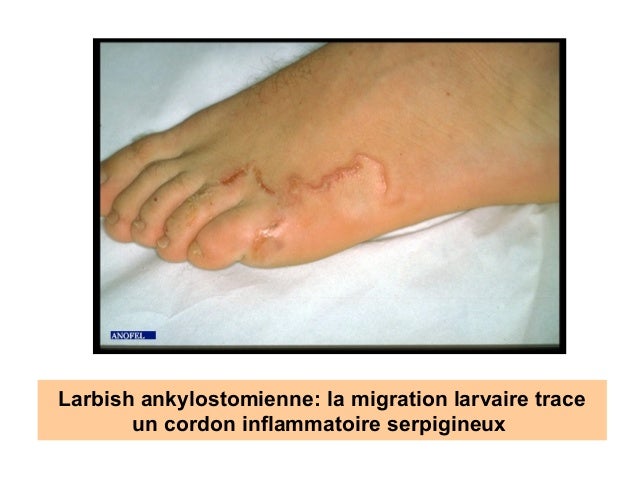 Toxocarose trichinellose