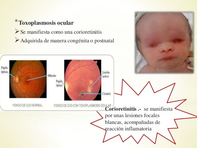 Analisis de Las caracteristicas Clinicas de la Toxoplasmosis