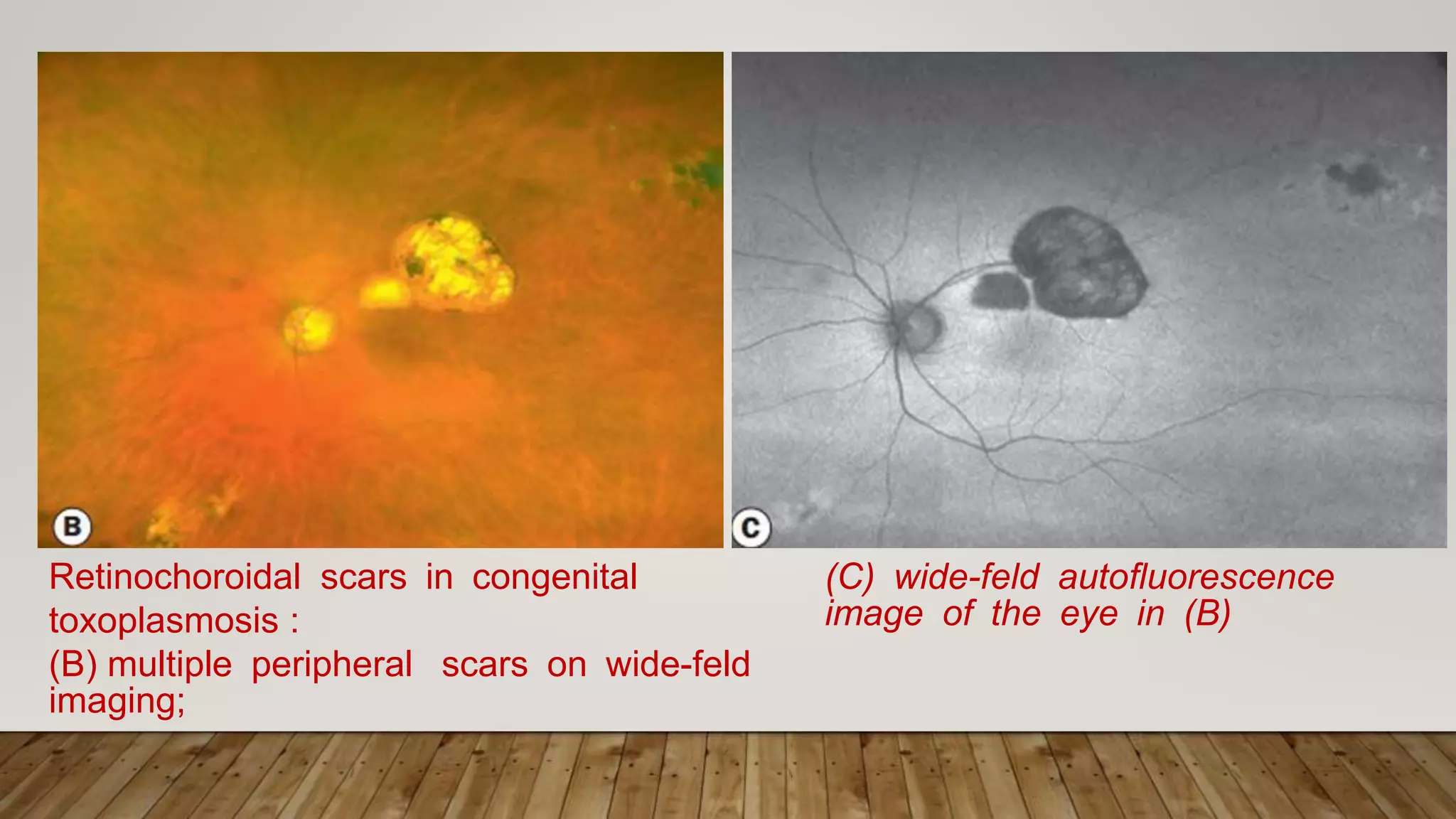 ocular Toxoplasmosis | PPTX