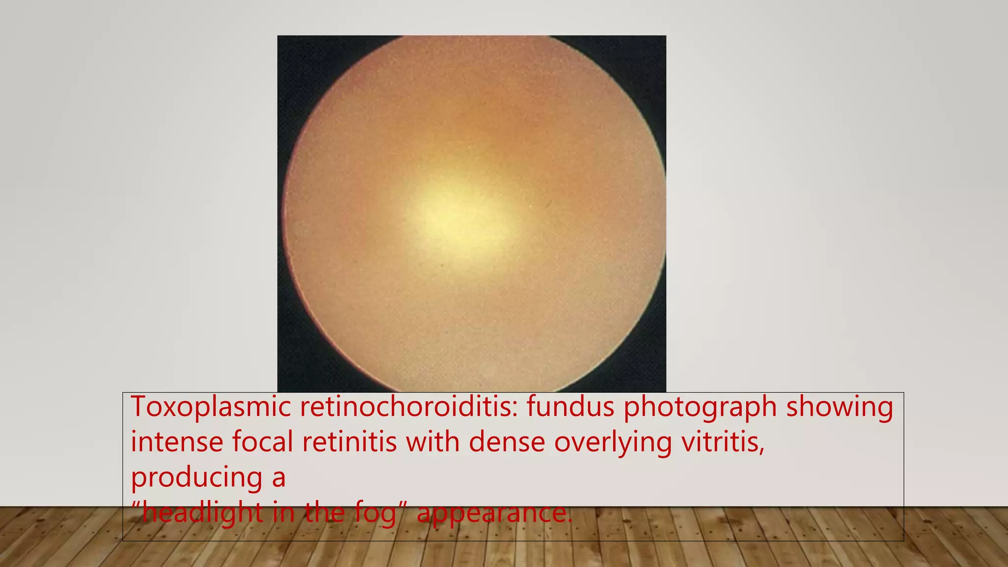 ocular Toxoplasmosis | PPTX