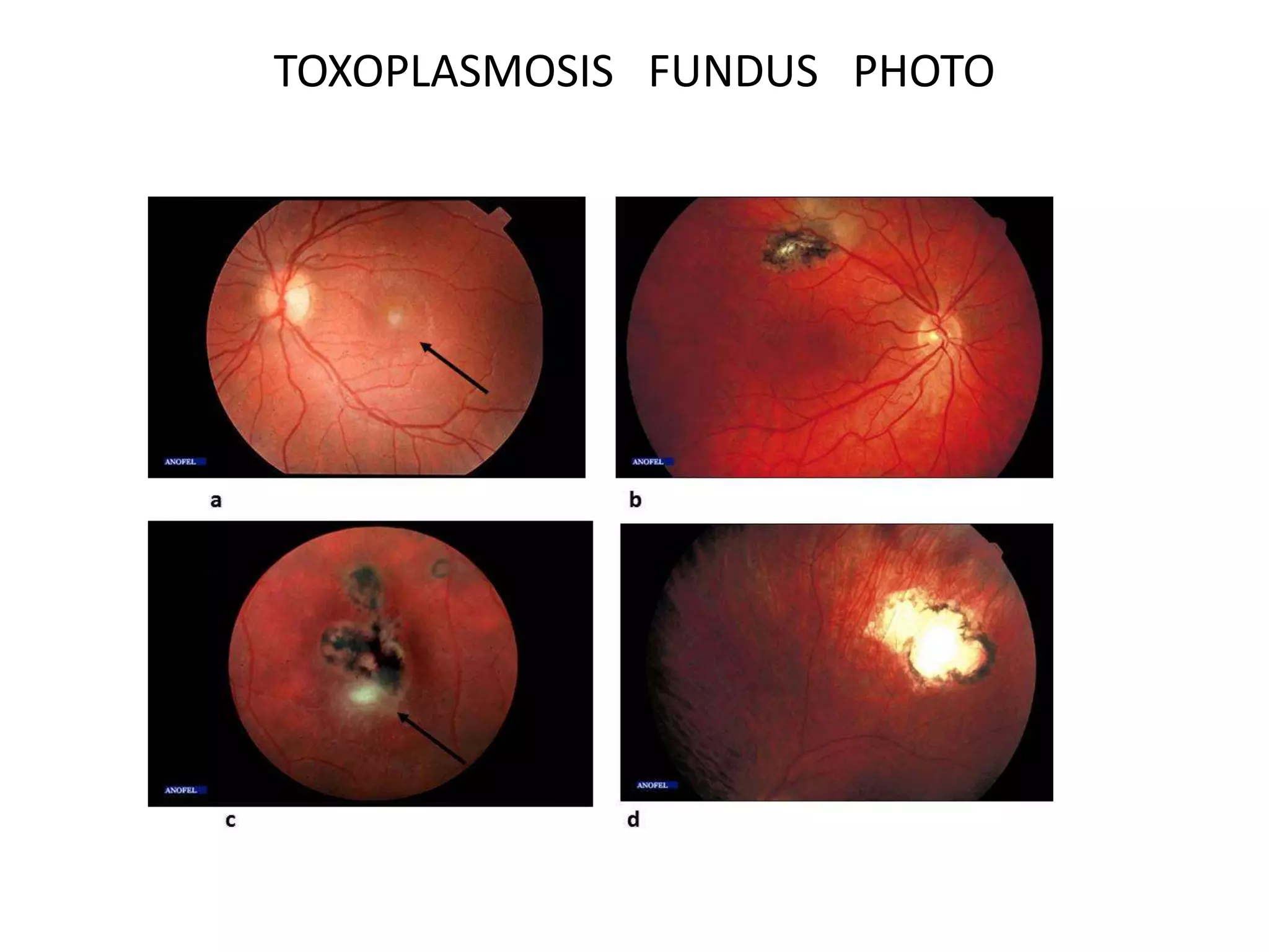 Toxoplasmosis | PPT