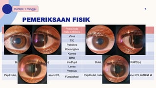 toxoplasmosis ocular caseeeeeeeeeeeeeeee | PPTX