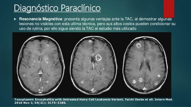 Toxoplasmosis cerebral sida