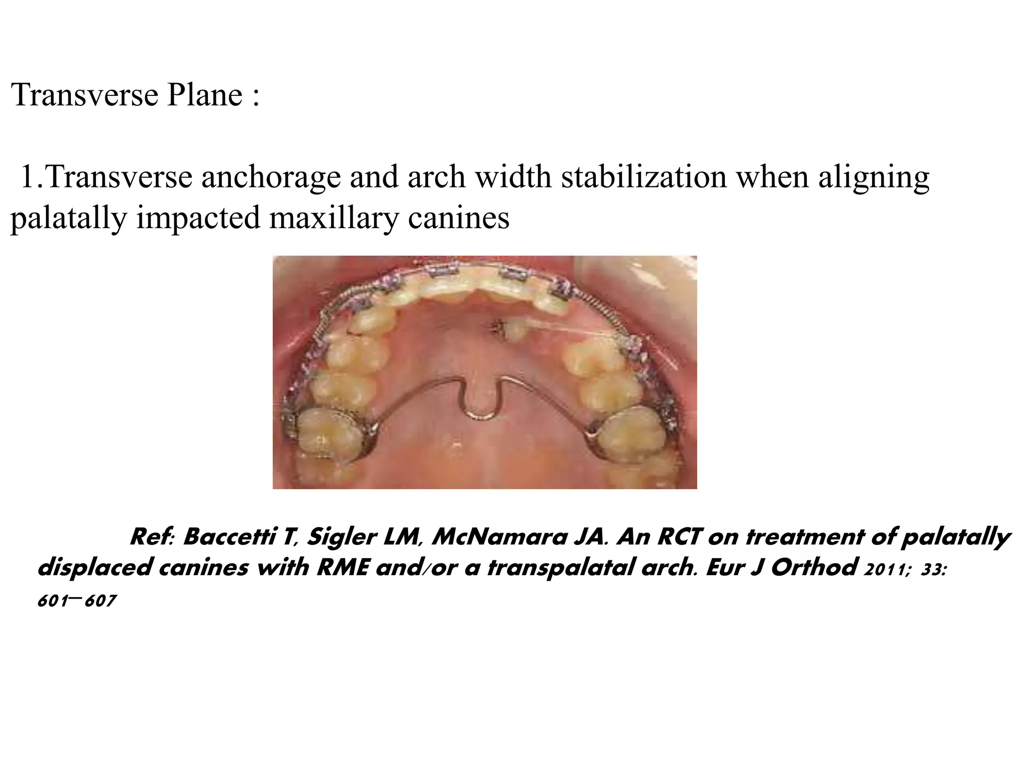 Trans Palatal Arch | PPTX