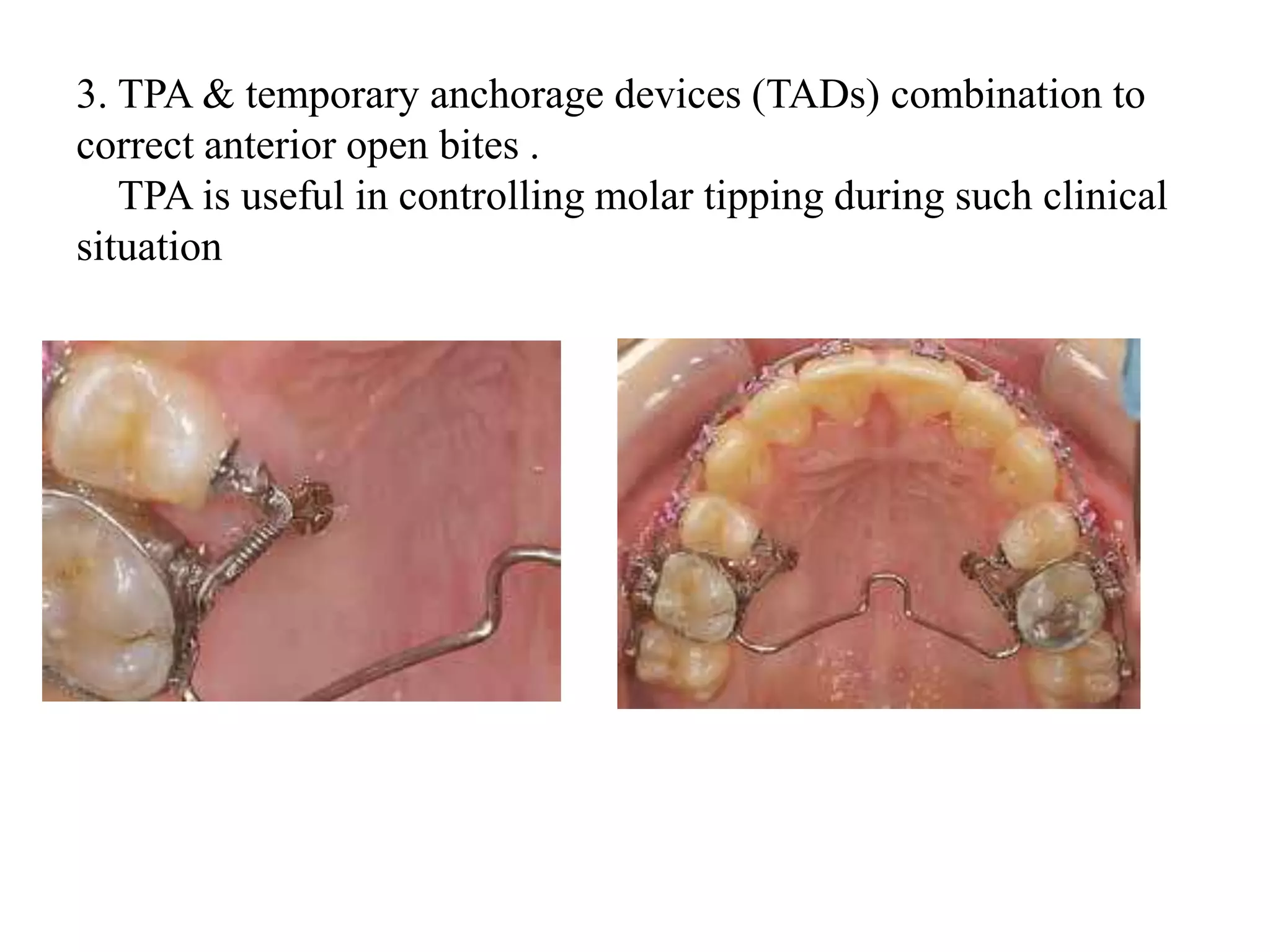 Trans Palatal Arch | PPTX