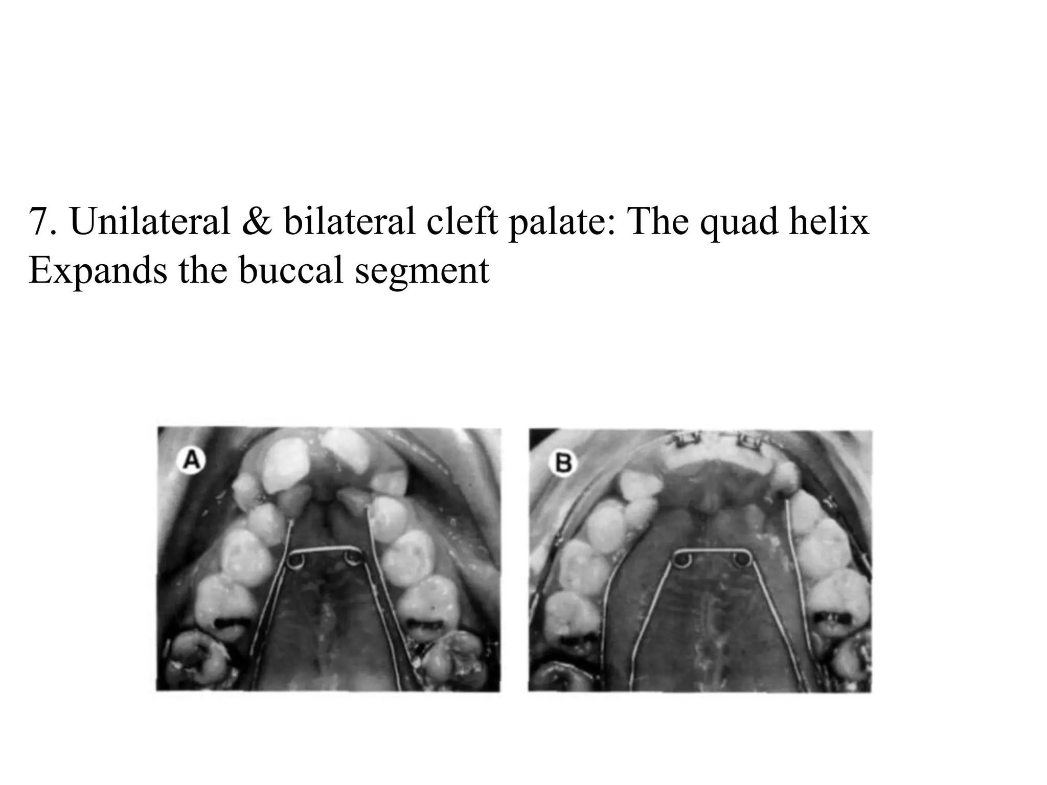 Trans Palatal Arch | PPTX
