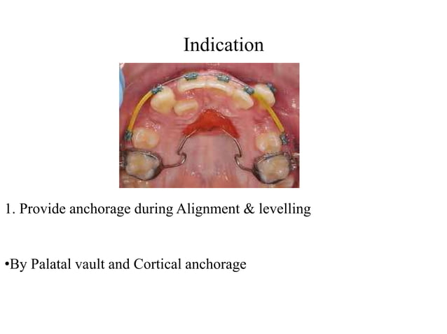 Trans Palatal Arch | PPTX | Dental Health | Diseases and Conditions