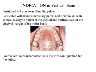 Trans Palatal Arch | PPTX