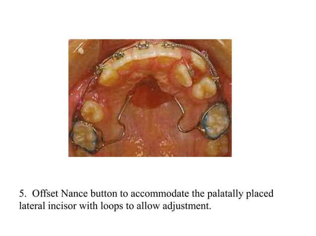 Trans Palatal Arch | PPTX | Dental Health | Diseases and Conditions