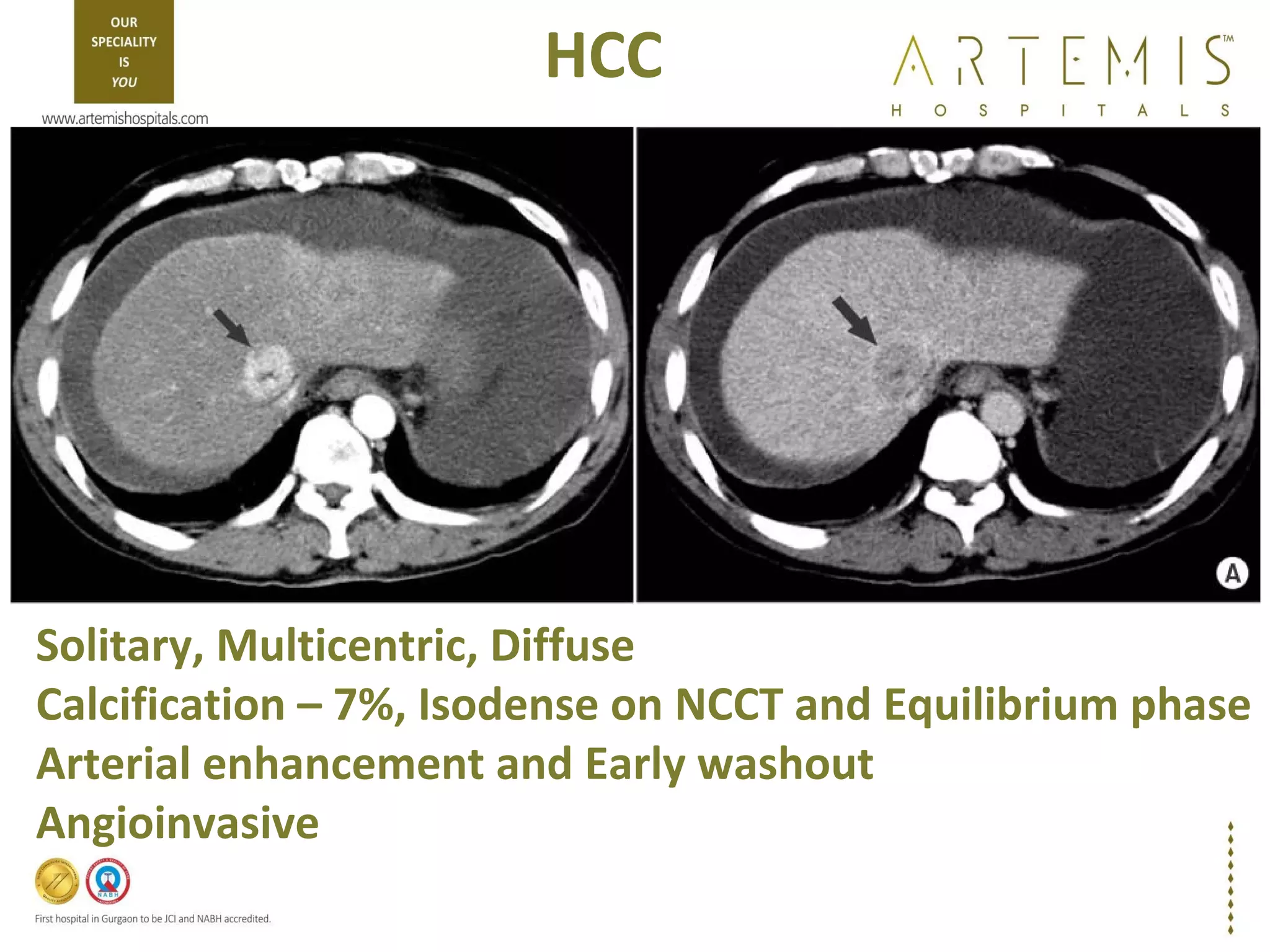 TPCT - Triphasic CT Scan - Liver | PPT
