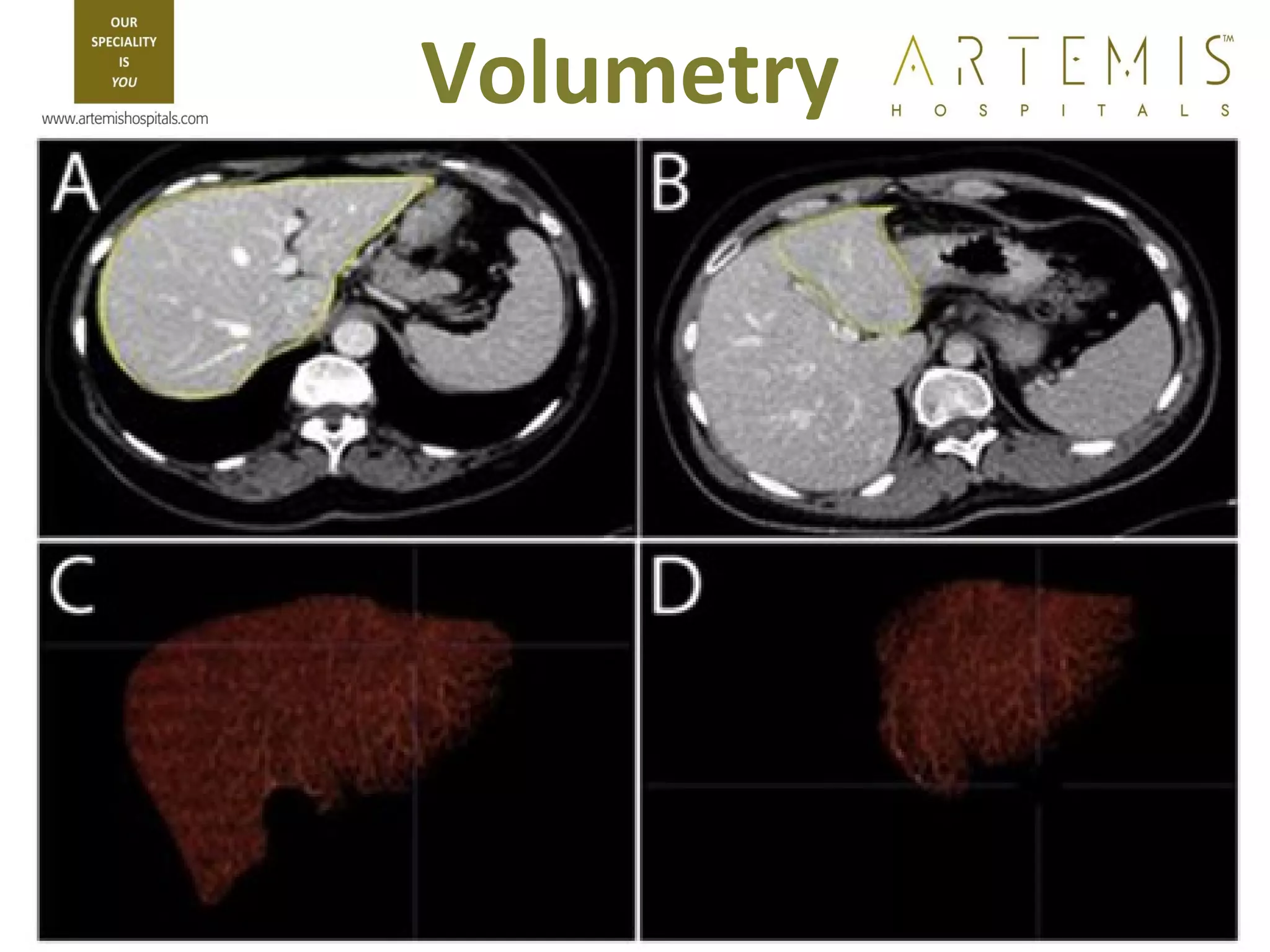 TPCT - Triphasic CT Scan - Liver | PPT