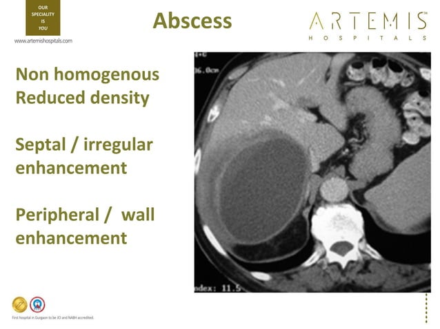 TPCT - Triphasic CT Scan - Liver | PPT