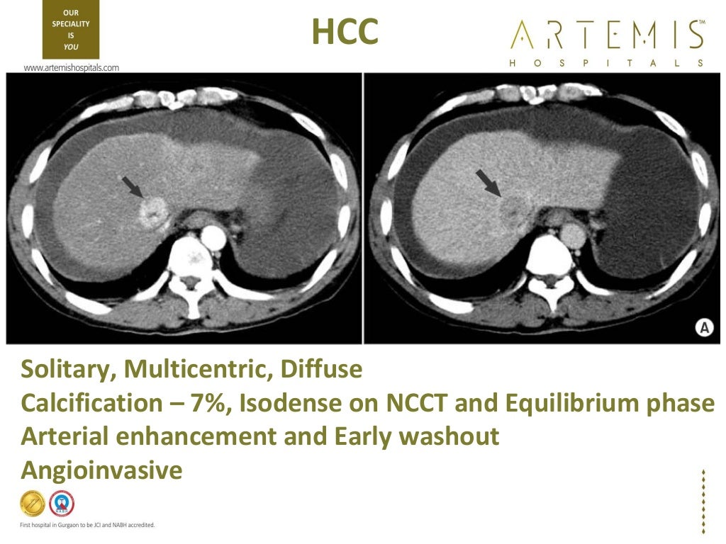 TPCT - Triphasic CT Scan - Liver