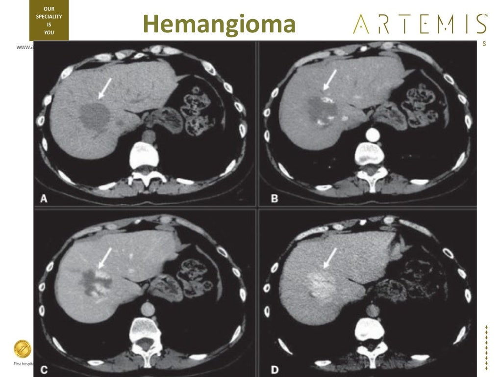 TPCT - Triphasic CT Scan - Liver