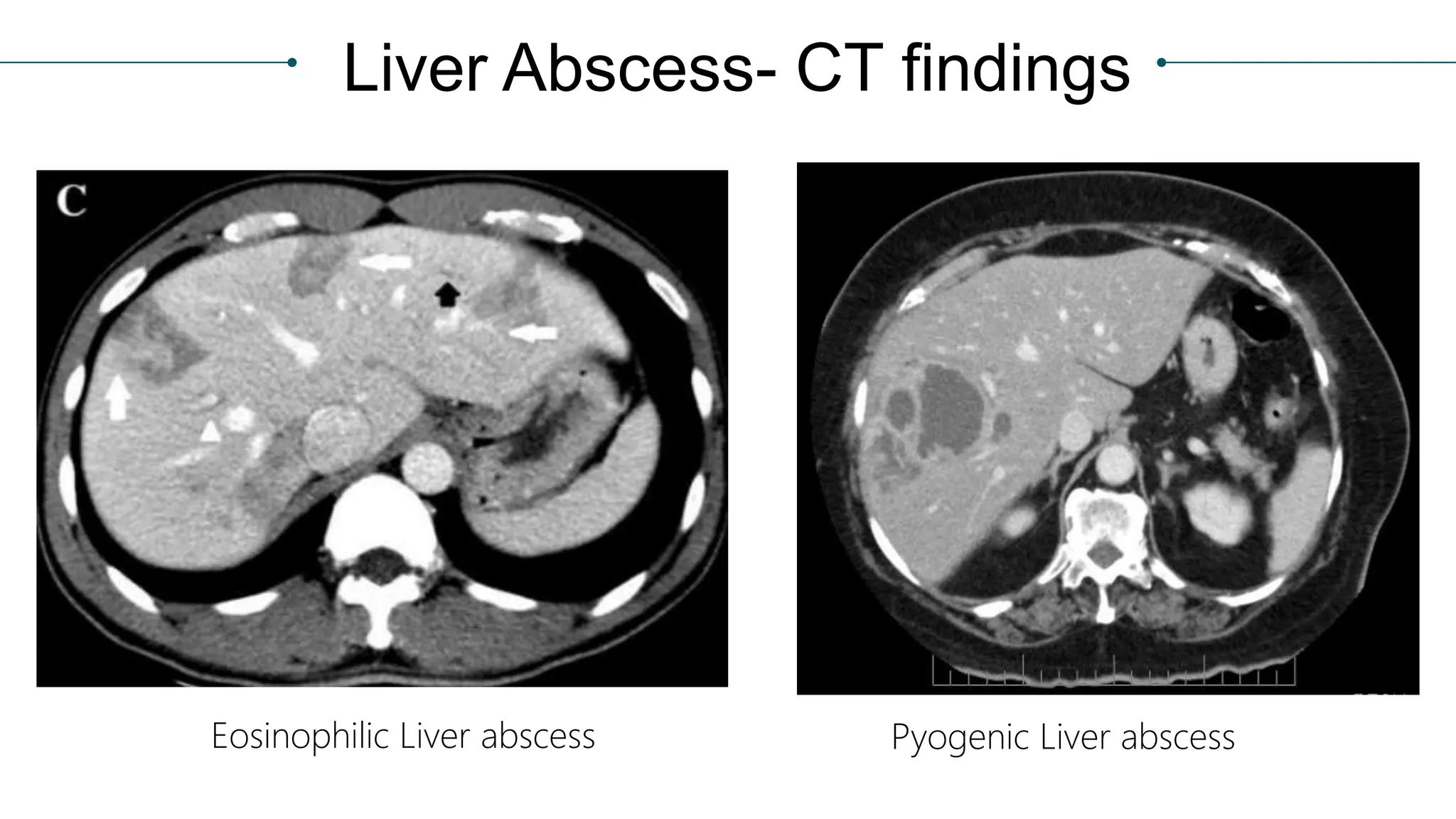 A Child with Eosinophilic liver abscess, Tropical pulmonary ...