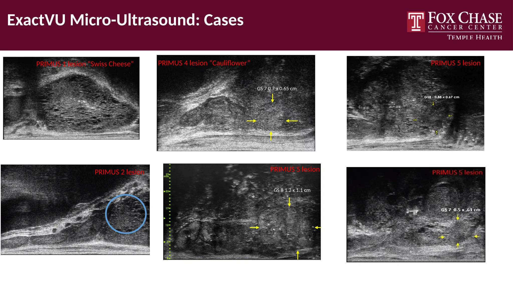 TP_ExactVU_ppt.pptx to describe or cancer | PPT