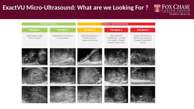 TP_ExactVU_ppt.pptx to describe or cancer | PPT