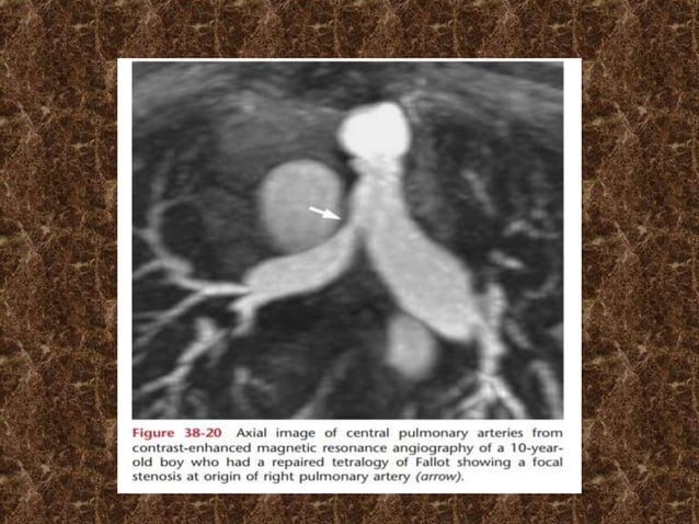 TETRALOGY OF FALLOT AND TET SPELL presentation | PPTX | Heart and ...