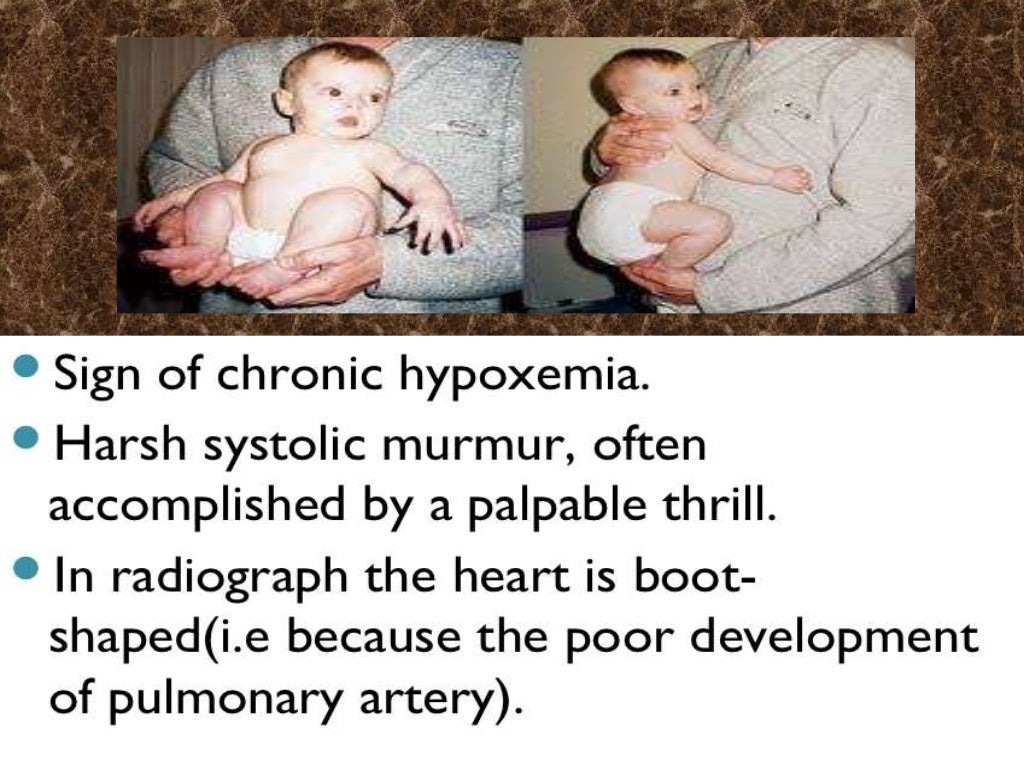 TETRALOGY OF FALLOT AND TET SPELL presentation