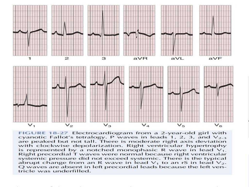 TETRALOGY OF FALLOT AND TET SPELL presentation