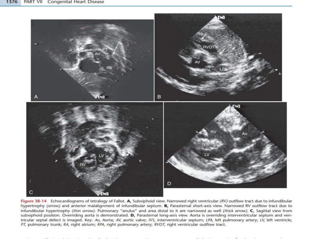 TETRALOGY OF FALLOT AND TET SPELL presentation