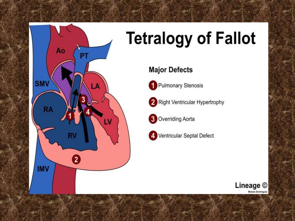 TETRALOGY OF FALLOT AND TET SPELL presentation