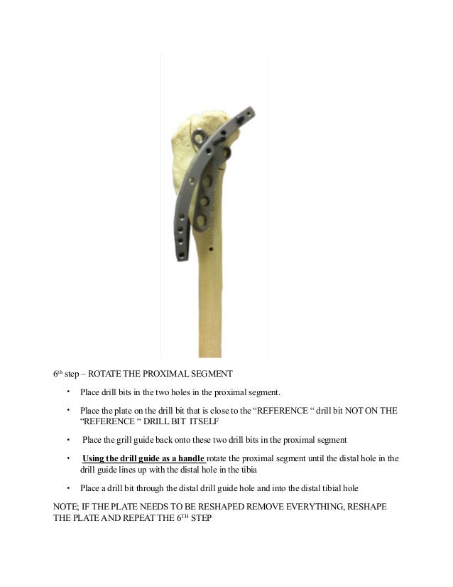 TPLO Procedure (Tibial Plateau Leveling Osteotomy) surgical instrumen…