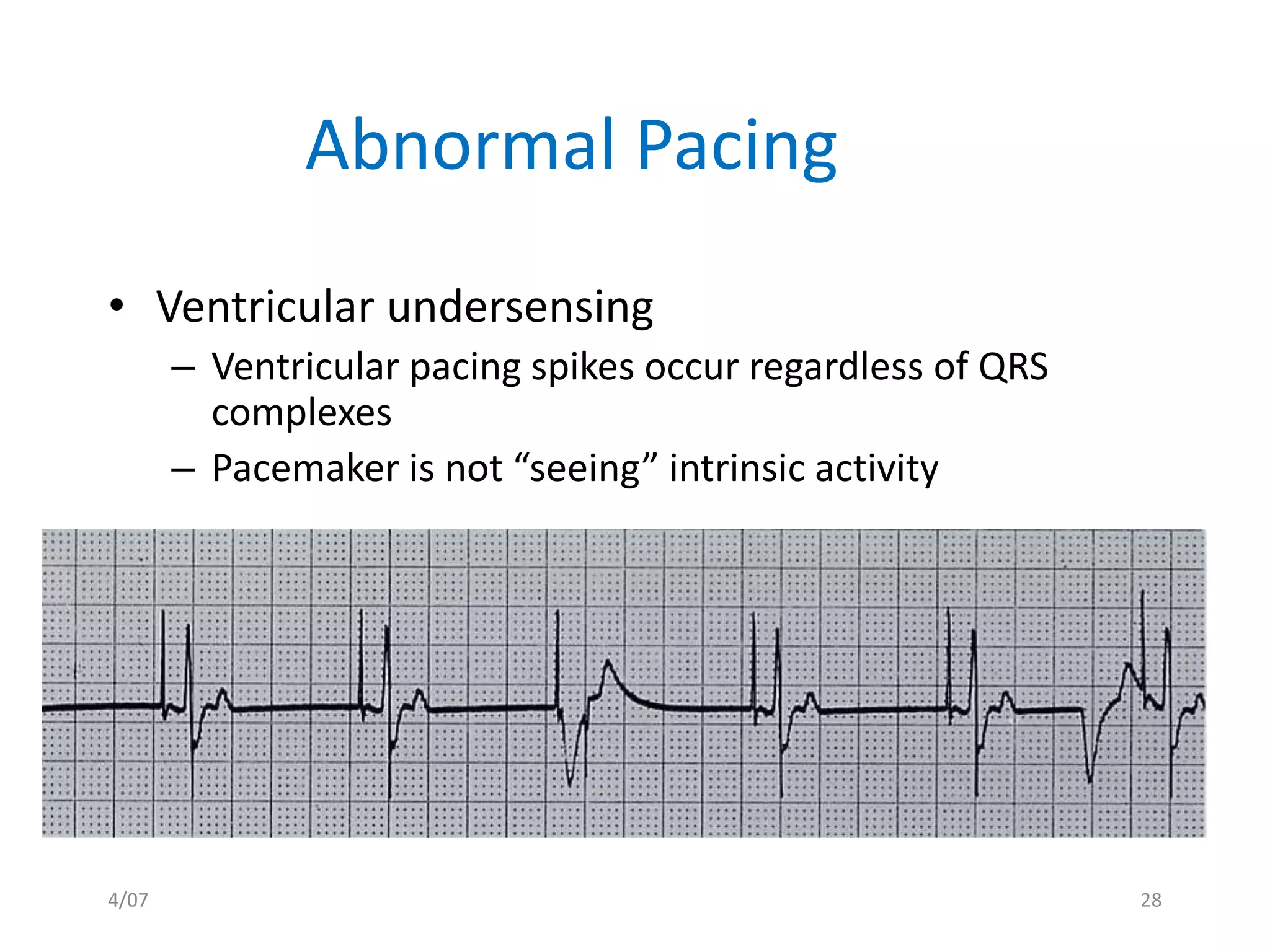 Temporary pacemaker toufiqur rahman | PPSX